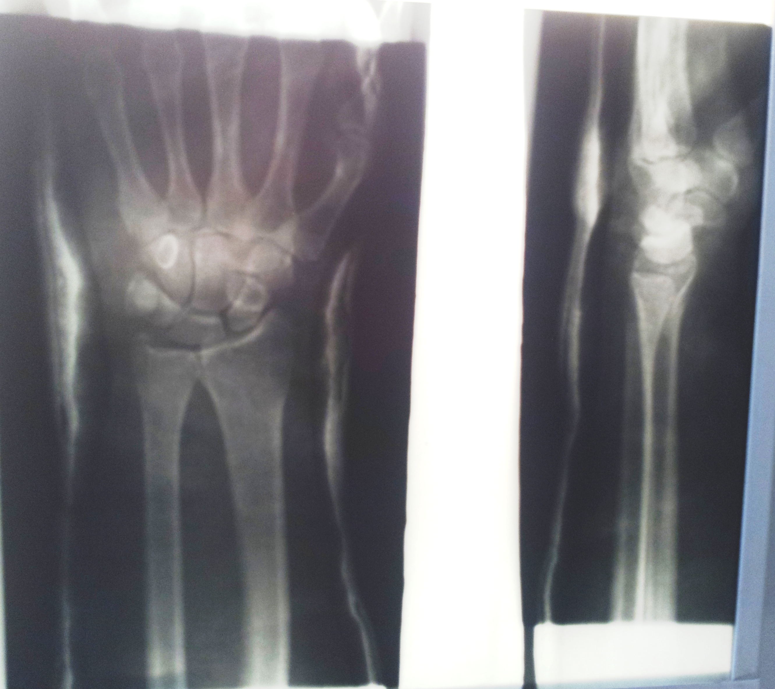 Radiografia de muñeca aportada como prueba - MTM